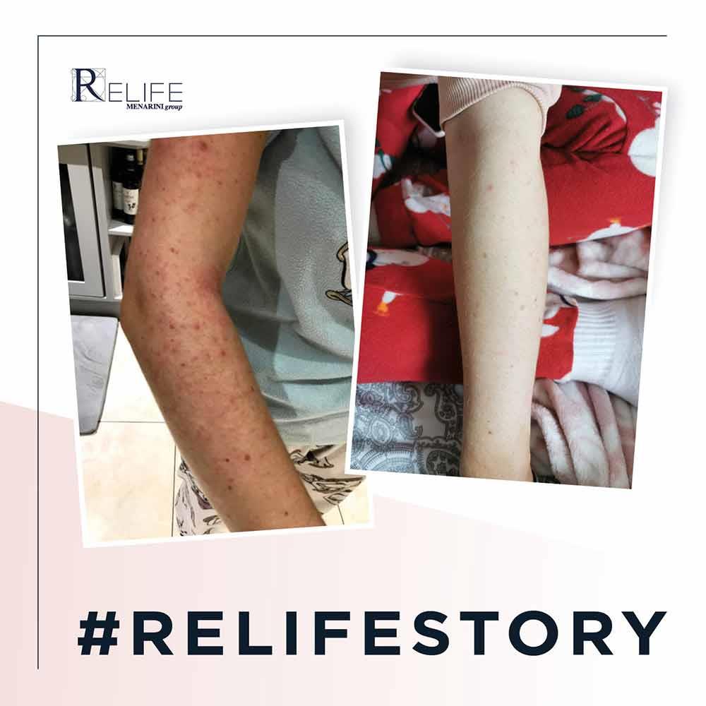 Relife Relizema Cream 40ml | Inish Pharmacy | Ireland